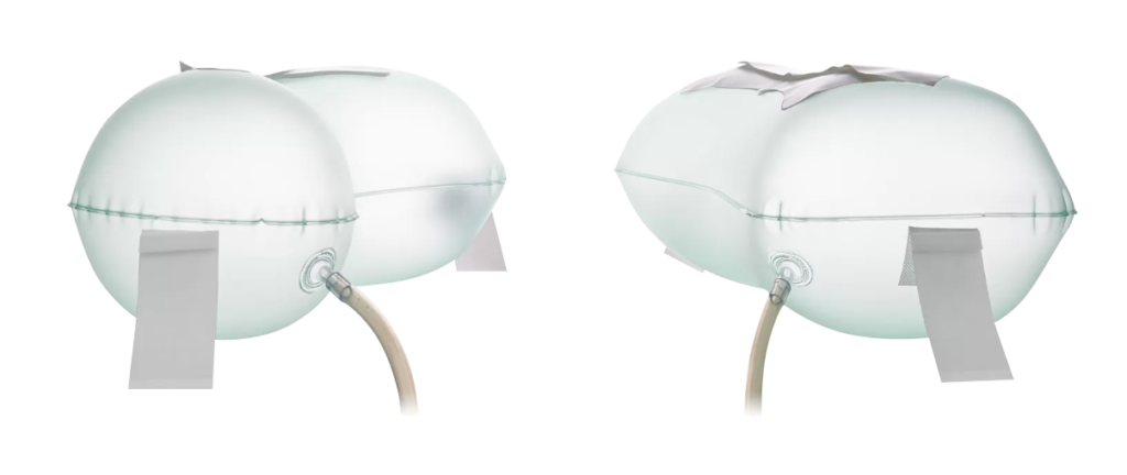 Ergotrics IPS®- Inflatable Prone Support | Hospital Direct